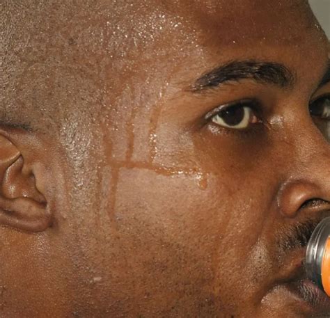 The Management Of Antidepressant Induced Excessive Sweating