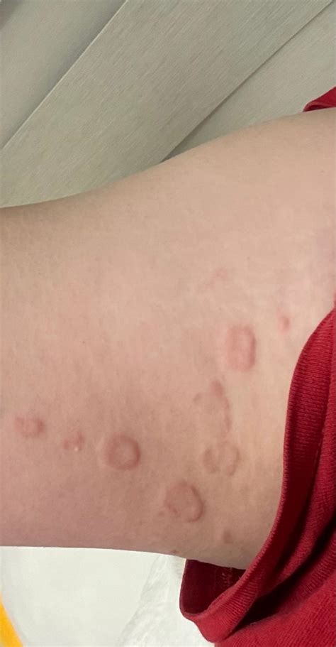 도넛모양 두드러기 지식in