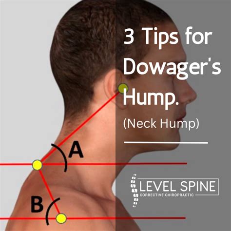 How Do I Get Rid Of Neck Hump From Bad Posture