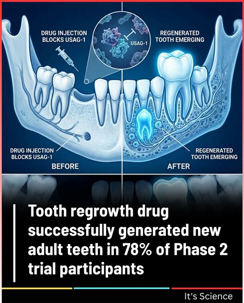 Its Tooth Regrowth Drug Successfully Generated New Adult Teeth In 78 Of Phase 2 Trial