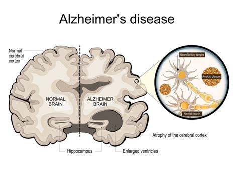 Using Mri To Diagnose And Monitor Alzheimers Disease And Dementia