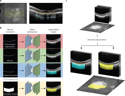 Clinically Relevant Deep Learning For Detection And Quantification Of Geographic Atrophy From