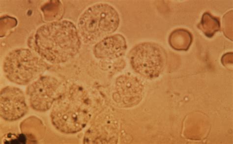 Clinical Findings In Renal Disease Flashcards Quizlet
