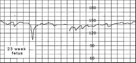Early Decelerations A Machine Learning Pipeline To Classify Foetal
