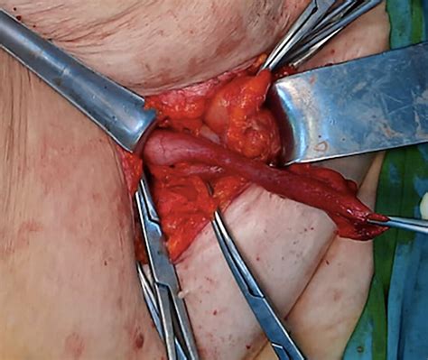 Intraoperative Image Showing The Inflamed And Congested Appendix Within