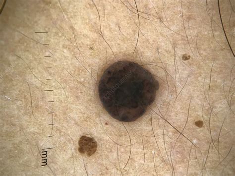 Mole Dermoscopy Stock Image C0602990 Science Photo Library