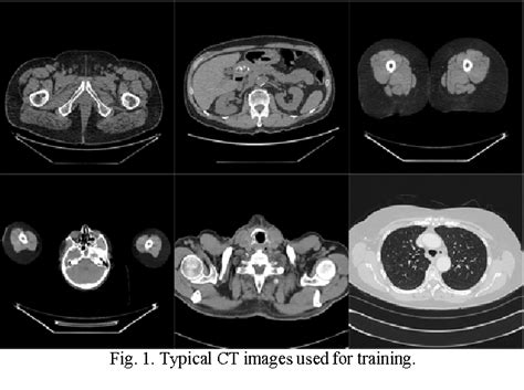 Figure 1 From Low Dose Ct Denoising With Convolutional Neural Network
