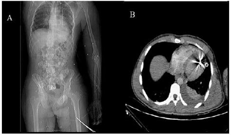 Journal Of Clinical Images And Medical Case Reports