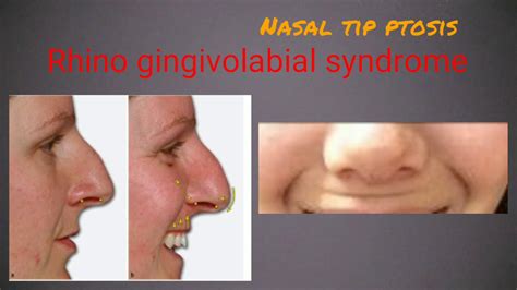 Nasal Tip Lift And Nasal Flare Correction By Botox Youtube