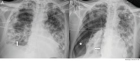 Radiologic Aspects Of Covid 19 Pneumonia Outcomes And Thoracic