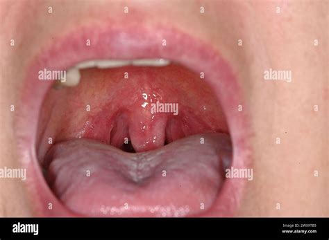 Viral Tonsillitis