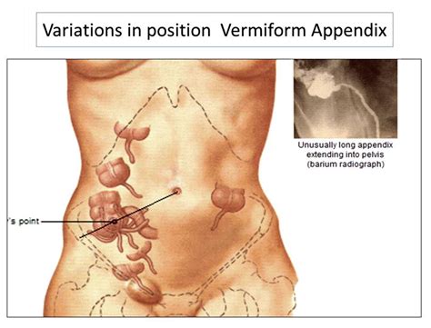 Appendix Location Variation