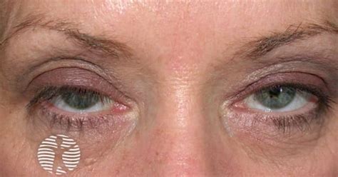 BOTOX Injections Image