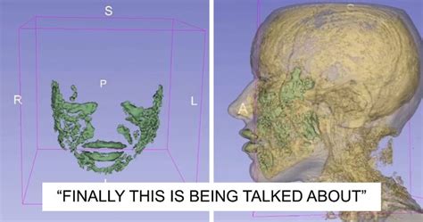 Mri Of 33 Year Old Womans Face Reveals Where All Her Filler Went