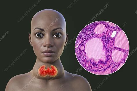 Woman With Enlarged Thyroid And Exophthalmos Illustration Stock Image F043 6091 Science
