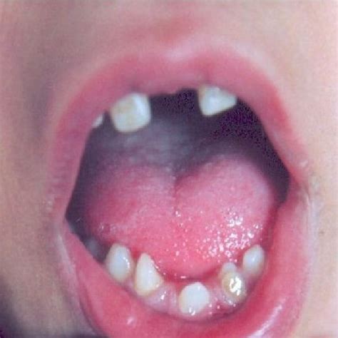 Diffuse Palmer Keratoderma With Arachnodactyly Of Hands And Feet