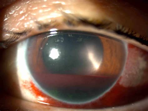 Vena Central De La Retina Oclusión De La Vena Central Crónica Se