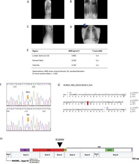 Unraveling Runx2 Mutation In A Cleidocranial Dysplasia Patient Molecular Insights Into