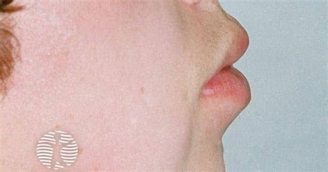 Granulomatous Cheilitis Image