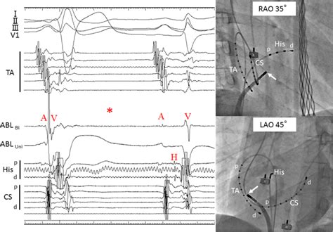 Electrograms From The Successful Ablation Site During Mapping Of The Download Scientific