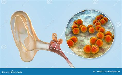 Otitis Media Inflammatory Disease Of The Middle Ear Stock Illustration