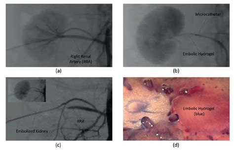 Flowing On The Horizon Liquid Embolics In Development Suvranu Ganguli