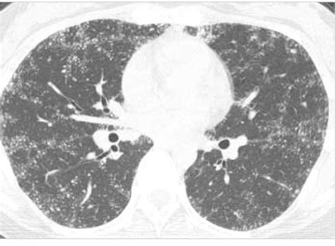 Chest Computed Tomography Shows Diffuse Micronodules And Ground Glass Download Scientific