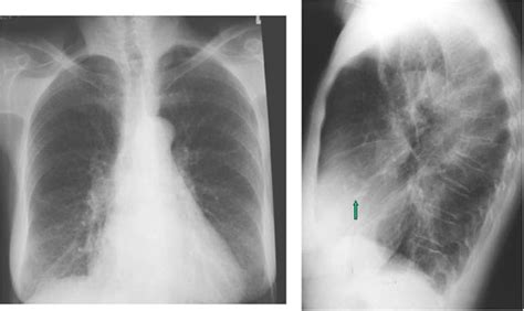 Aortic Valve Calcification Toronto Notes