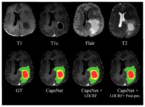 J Imaging Free Full Text Brain Tumor Segmentation Using Deep