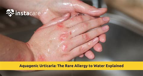 Aquagenic Urticaria Understanding The Rare Allergy To Water