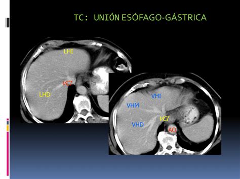 AnatomÍa RadiolÓgica Del HÍgado