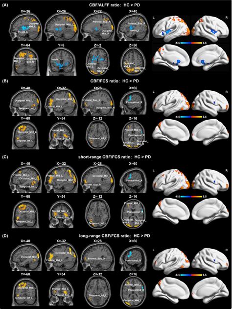 Figure 2 From Neurovascular Coupling Dysfunction Of Visual Network Organization In Parkinsons