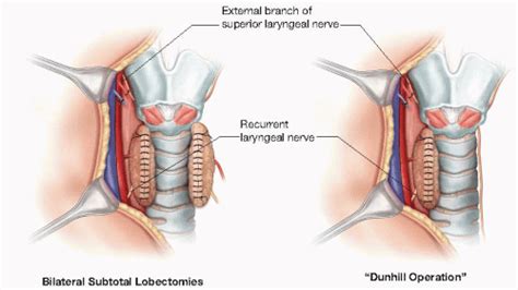 Subtotal Thyroidectomy For Graves Disease Basicmedical Key