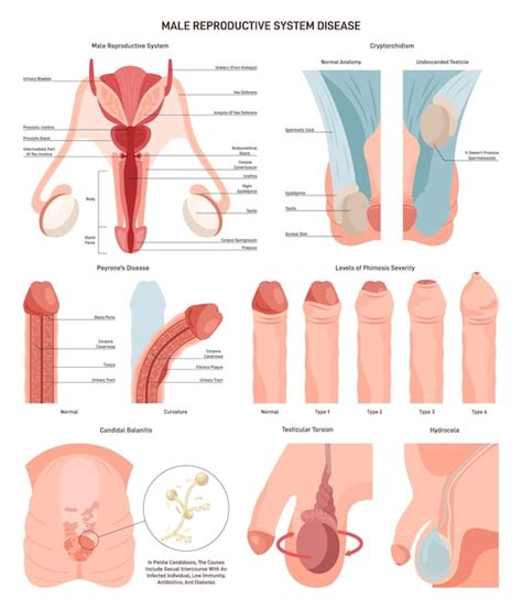 남성 생식기 장애 세트 외부 및 내부 장기 프리미엄 벡터