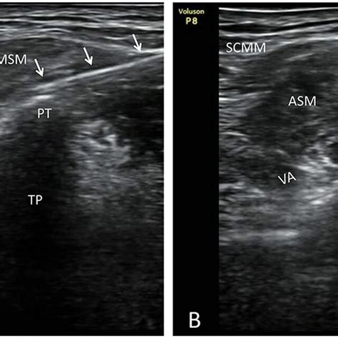 Posterior Tubercle Of The Seventh Cervical Transverse Process And