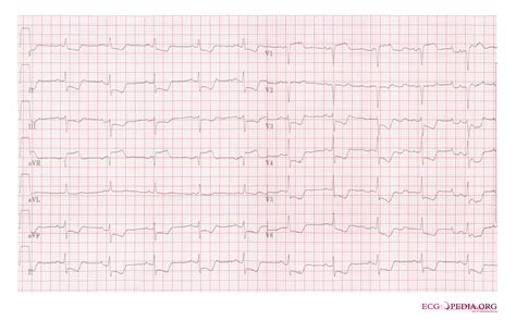 File Subendocardial Ischemia  Ecgpedia