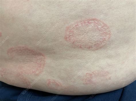 Erythema Annulare Centrifugum Stock Image C0562438 Science Photo