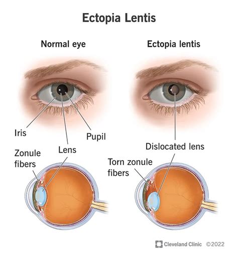 What Is Marfan Syndrome Surgical Eye Center