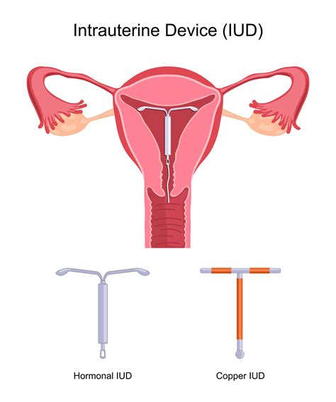 Intra Uterine Device Iud Singapore Ezra Clinic