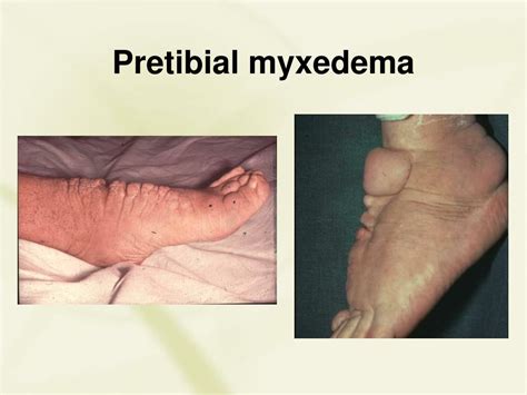 Ppt Endocrinology Review Thyroid Pituitary Adrenal And Bone Powerpoint Presentation Id 3325463