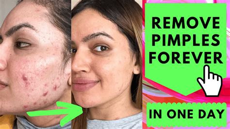 Video How To Remove Pimples Forever Ayurvedic Expert