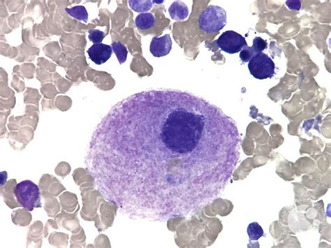 Hypolobated Megakaryocyte