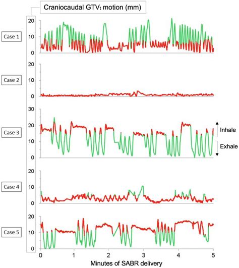 Delivery Of Magnetic Resonance Guided Single Fraction Stereotactic Lung Radiotherapy Pmc