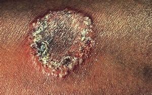 Body Ringworm Tinea Corporis Skin Disorders Merck Manual Consumer