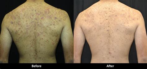 Back Acne Rash At Gabriel Basser Blog