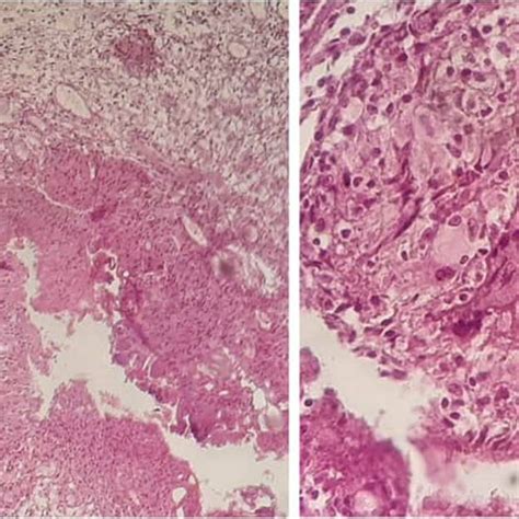 Microbiologic Examination Of Tissue And Abscess Samples Revealed Download Scientific Diagram