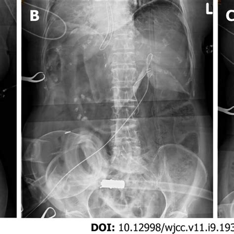 Intraoperative Cholangiograms During Transcystic Choledocholithotripsy Download Scientific