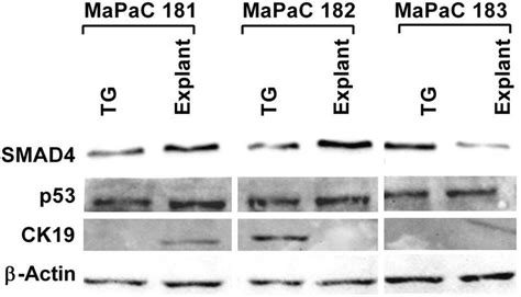 Expression Of Pancreatic Cancer Markers In Three Processed Pancreatic