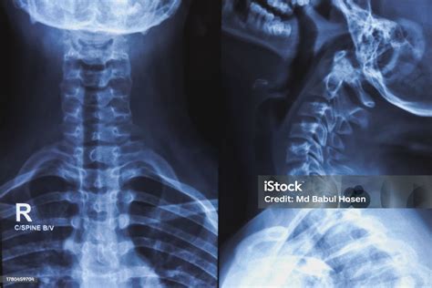 Photo Of Human Neck Xray Image Xray Of Cervical Spine Ap And Lateral