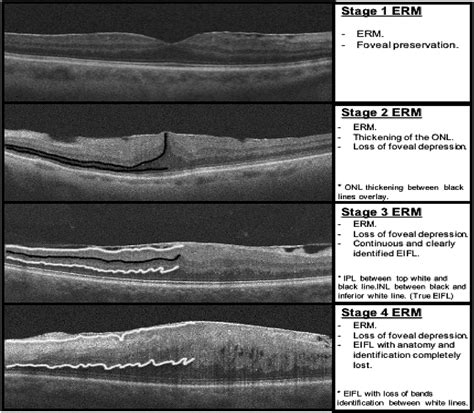Ectopic Inner Foveal Layer Classification Scheme Predicts Vi Retina
